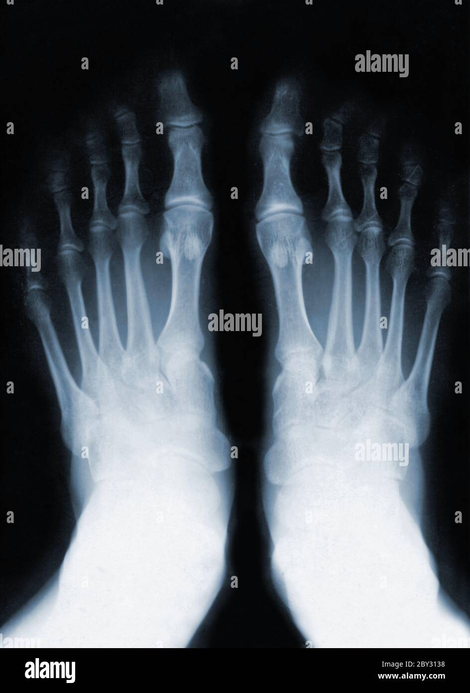 Broken toe xray hi-res stock photography and images - Alamy