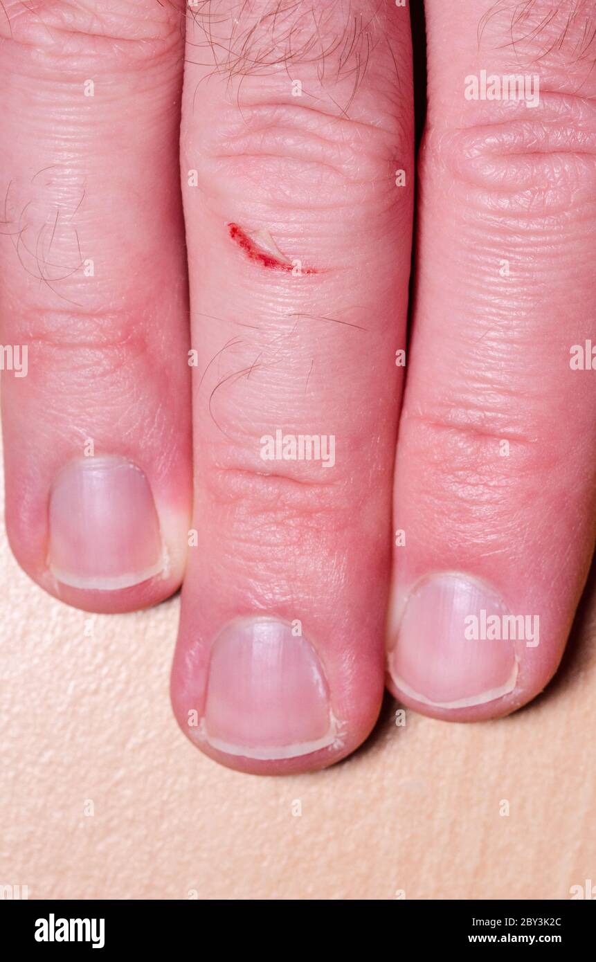 Cut finger blood hi-res stock photography and images - Alamy