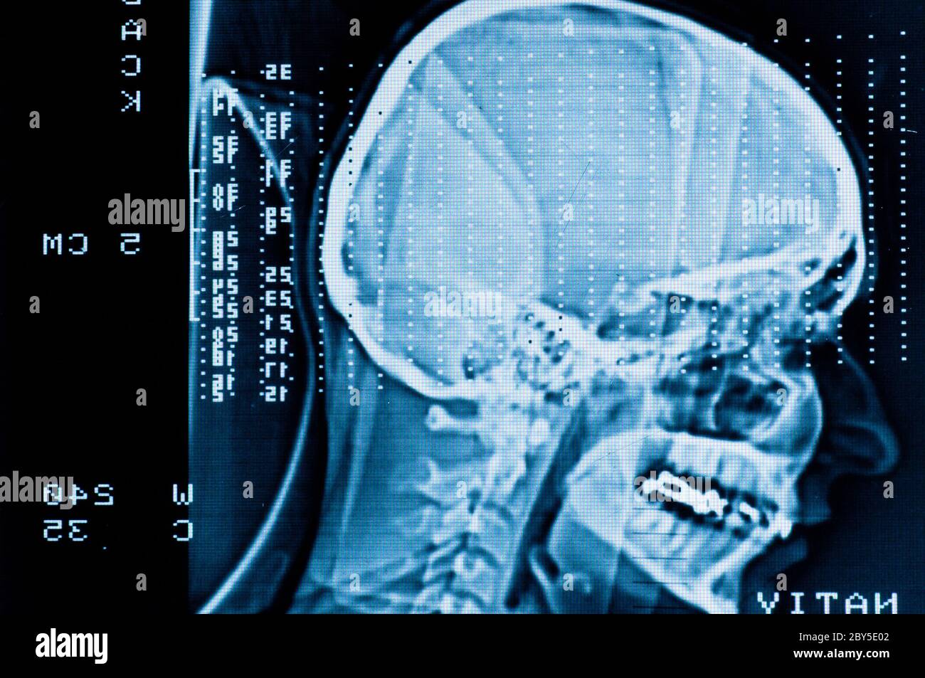 Ct scan skull injury hi-res stock photography and images - Alamy