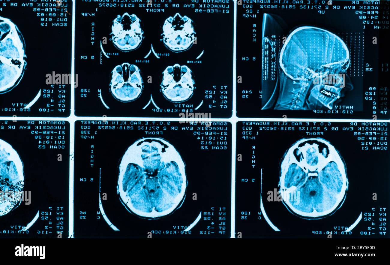 Mri Of Top Brain High Resolution Stock Photography and Images - Alamy