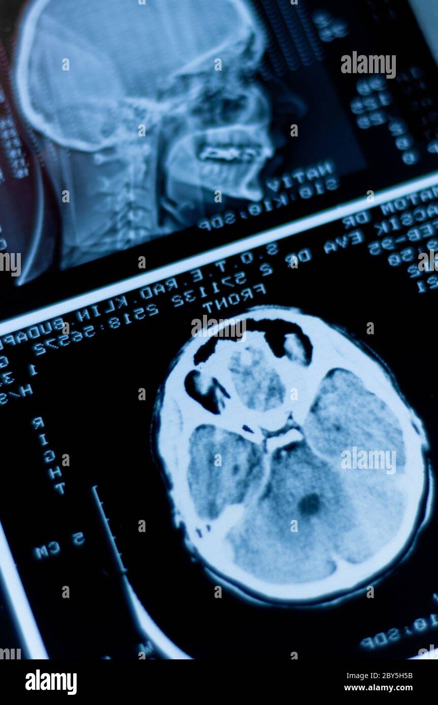 Ct scan skull injury hi-res stock photography and images - Alamy