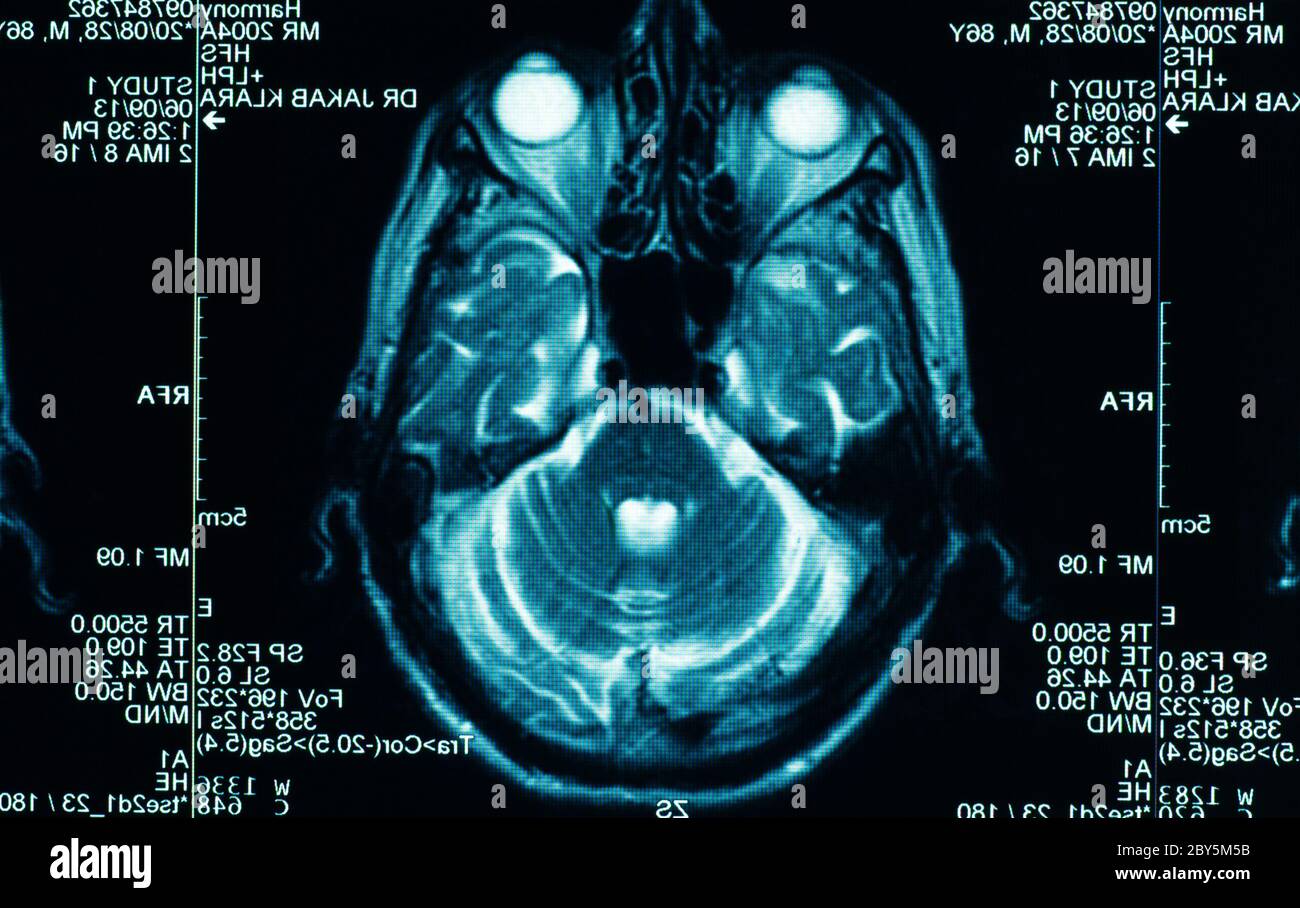 Mri of top brain hi-res stock photography and images - Alamy