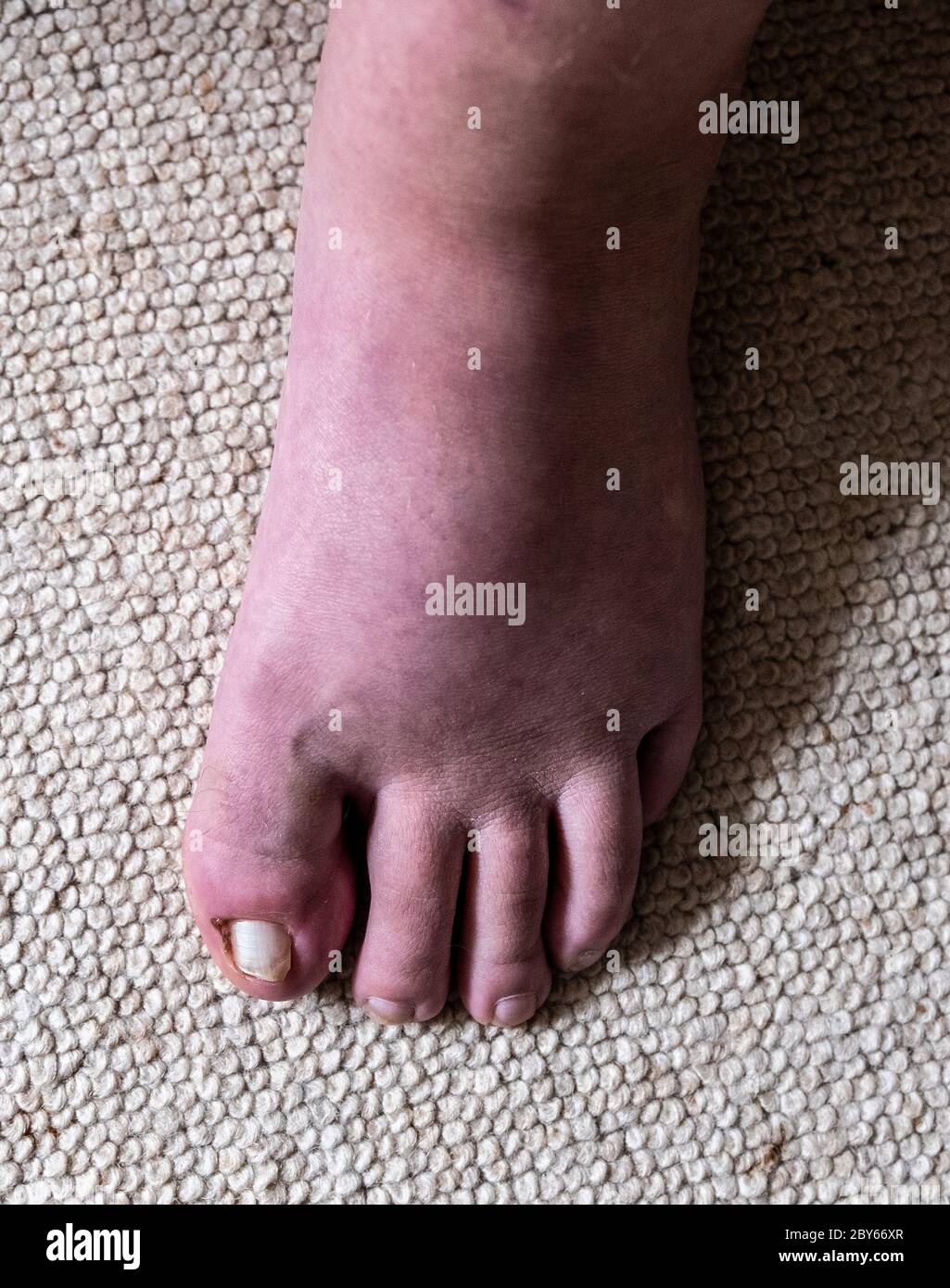 Patient after a few days of healing showing toe with one toenail ...