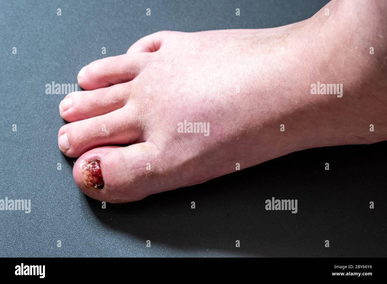 Toe removed hi-res stock photography and images - Alamy