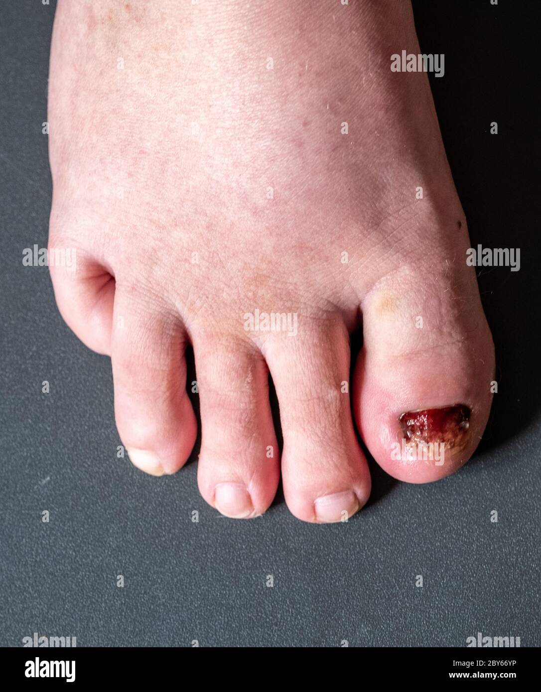 Patient after a few days of healing showing toe with one toenail ...