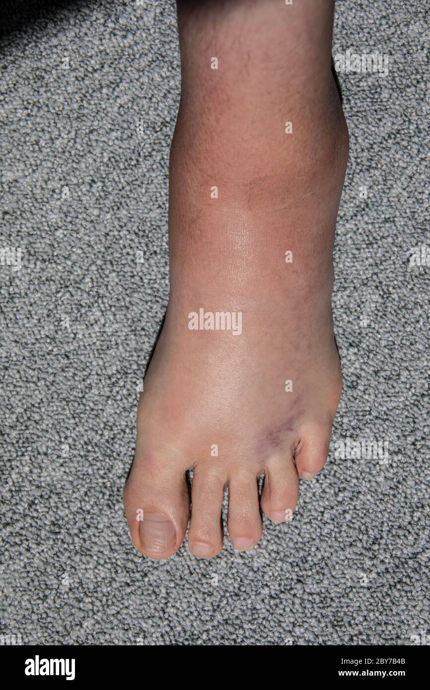 severe swelling and hematoma of the left foot after bending and ...