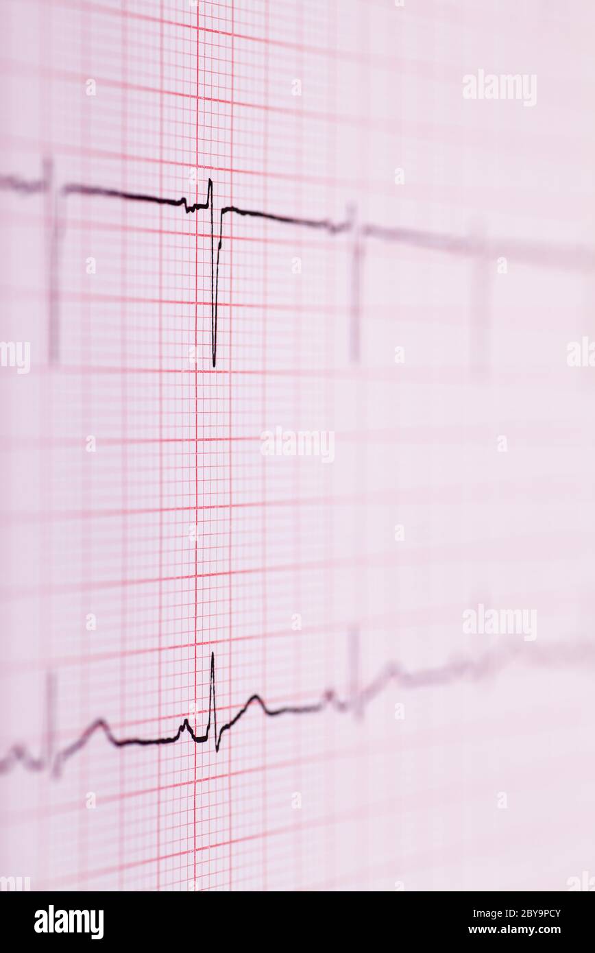 Ecg graph hi-res stock photography and images - Alamy