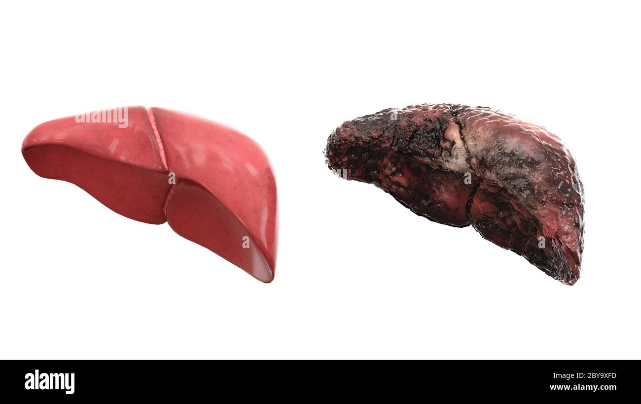 healthy liver and disease liver on white isolate. Autopsy medical ...