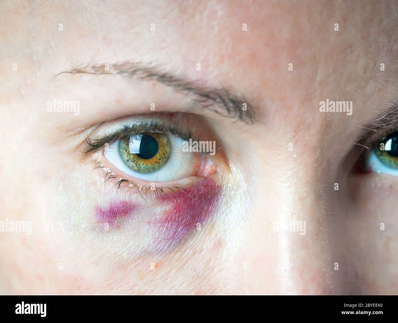 bruise under an eye. The prick got to a vessels Stock Photo - Alamy