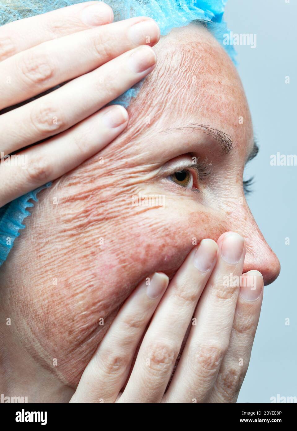 Chemical peeling. Parchment skin before rejectio Stock Photo - Alamy