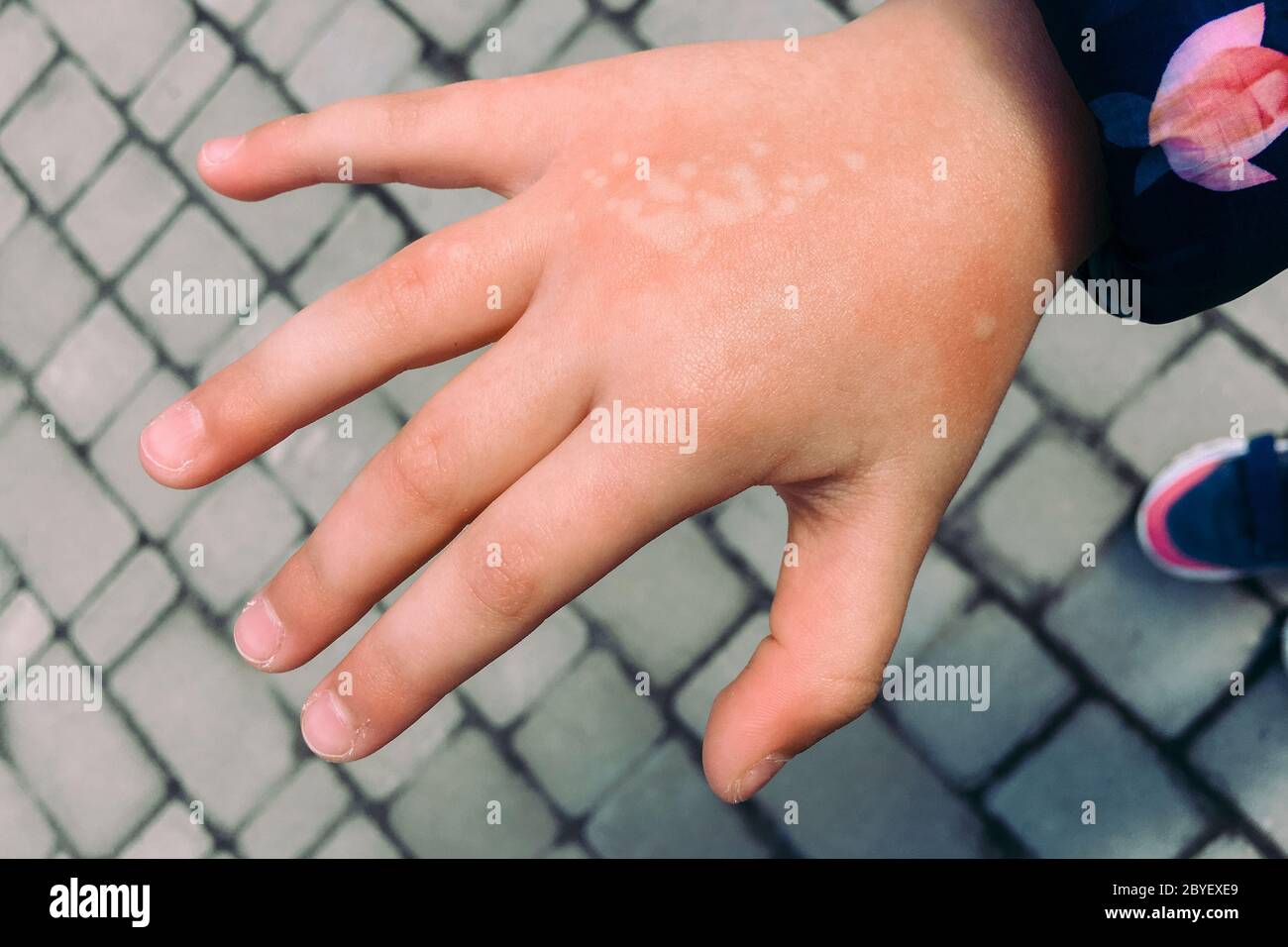 Burned finger hi-res stock photography and images - Alamy