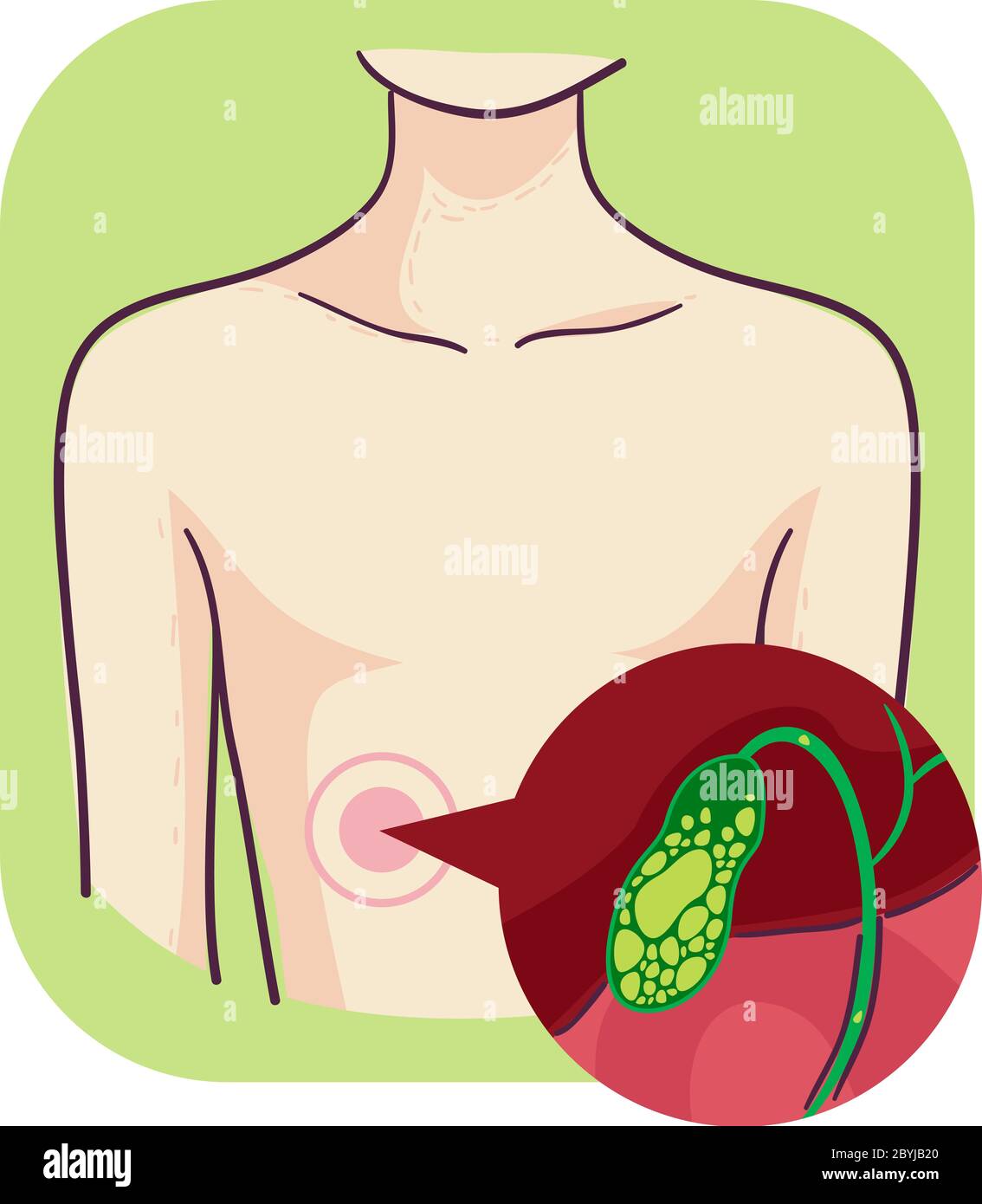 Gallstones hi-res stock photography and images - Alamy