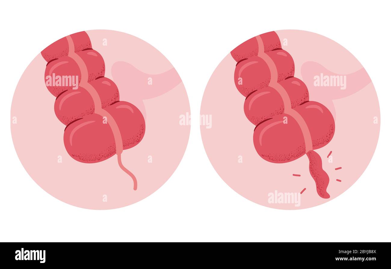 Illustration of Inflammation of the Appendix with Appendicitis and a ...