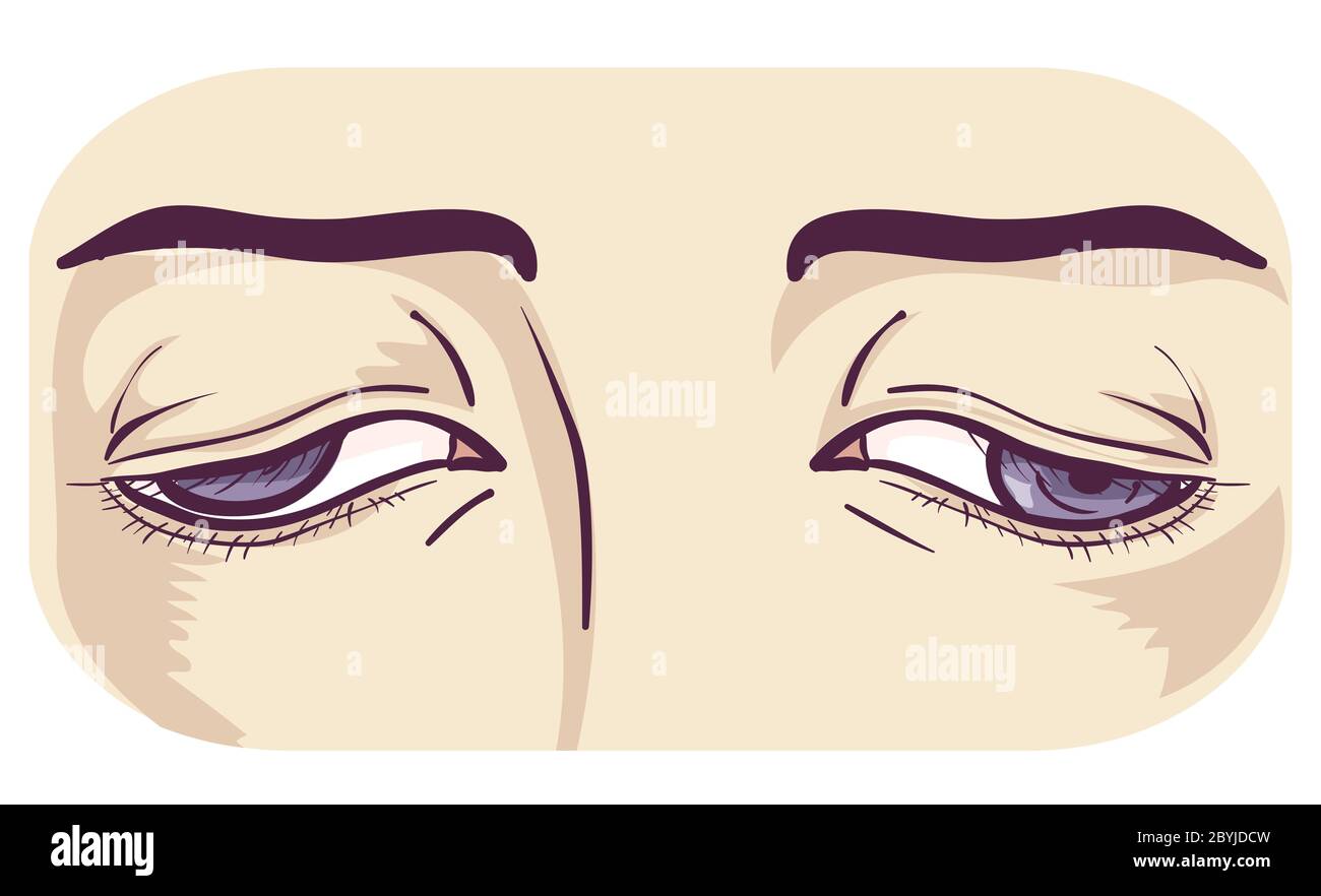Illustration of Eyes with Weakness in Muscle Holding the Eye in Place ...