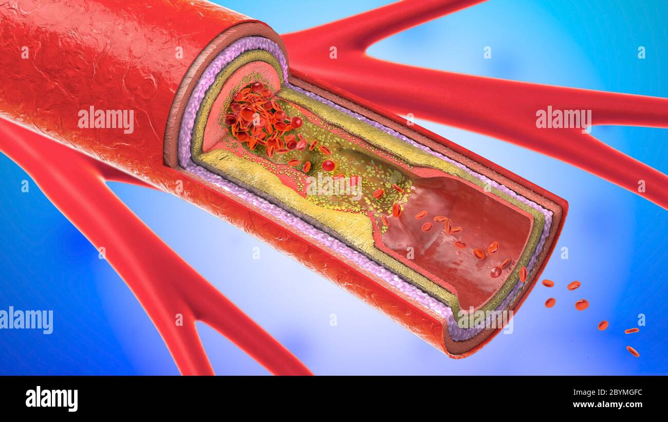 Blood vessel constriction hi-res stock photography and images - Alamy