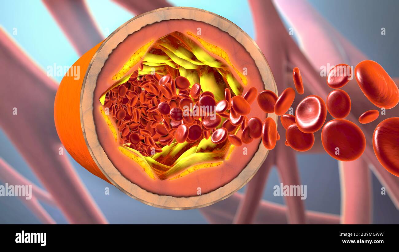 3d illustration of a precipitated and narrowing blood vessels or ...