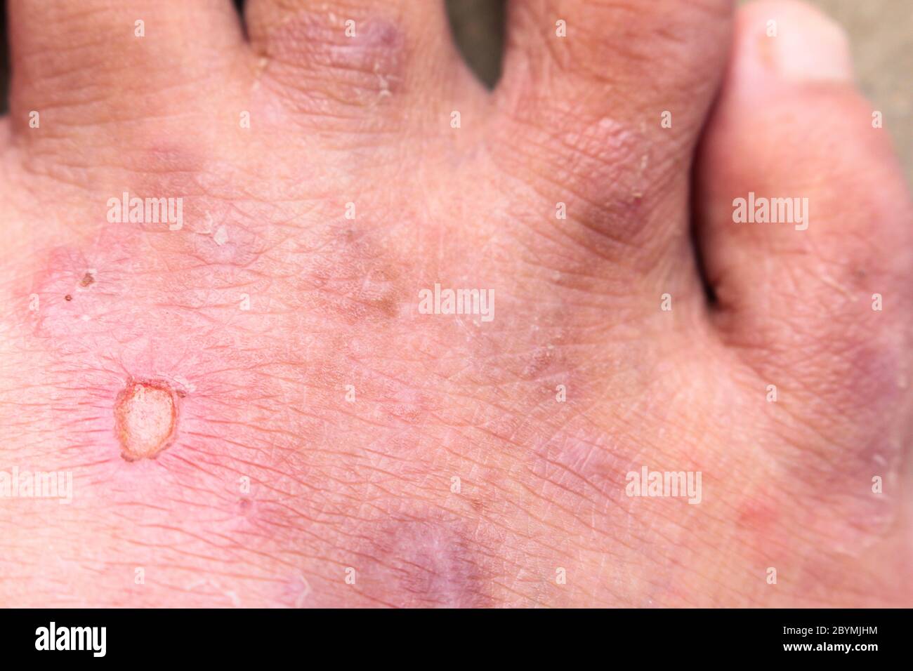 closeup skin athlete’s foot psoriasis fungus, hong kong foot, foot ...