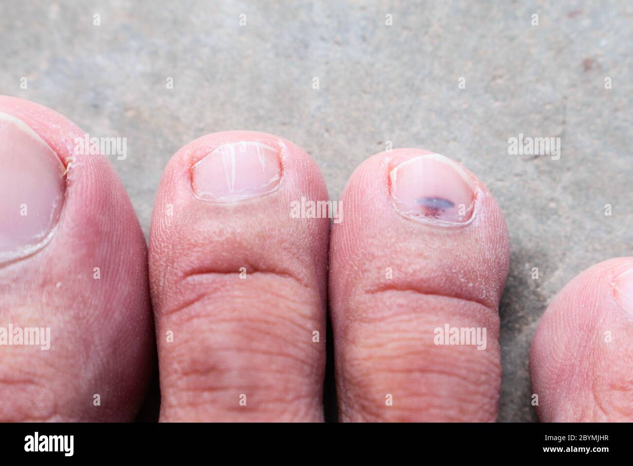 closeup skin athlete’s foot psoriasis fungus, hong kong foot, foot ...