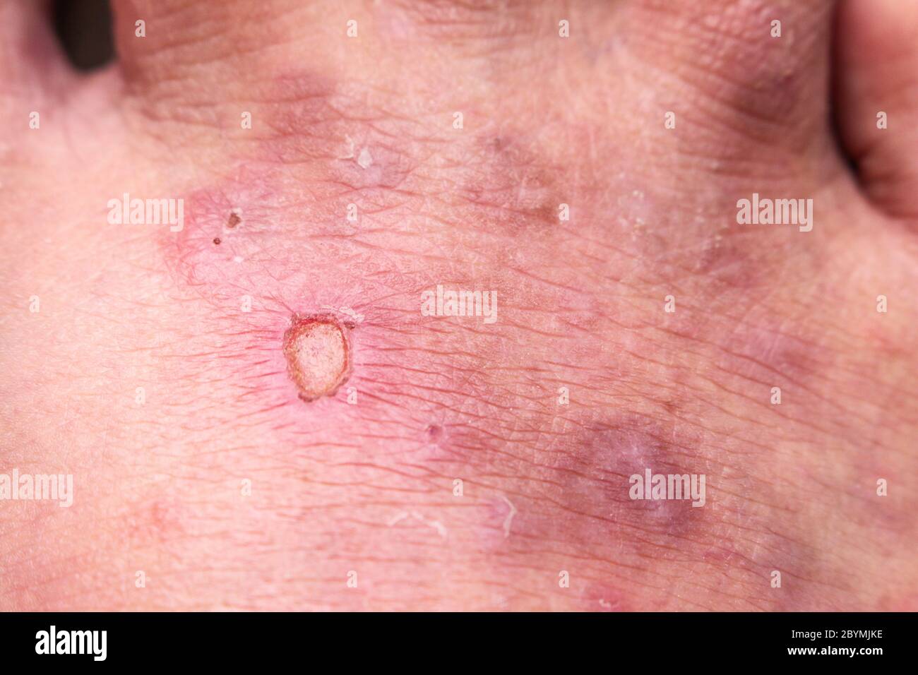 closeup skin athlete’s foot psoriasis fungus, hong kong foot, foot ...