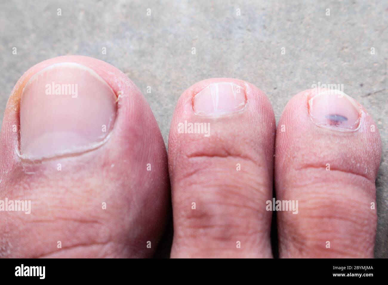 closeup skin athlete’s foot psoriasis fungus, hong kong foot, foot ...