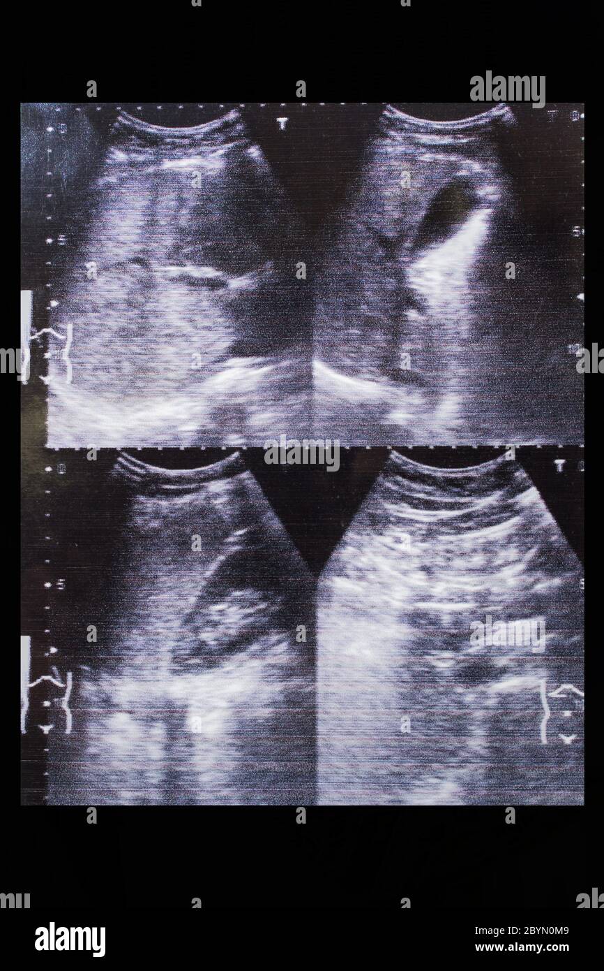 Gallbladder ultrasound hi-res stock photography and images - Alamy