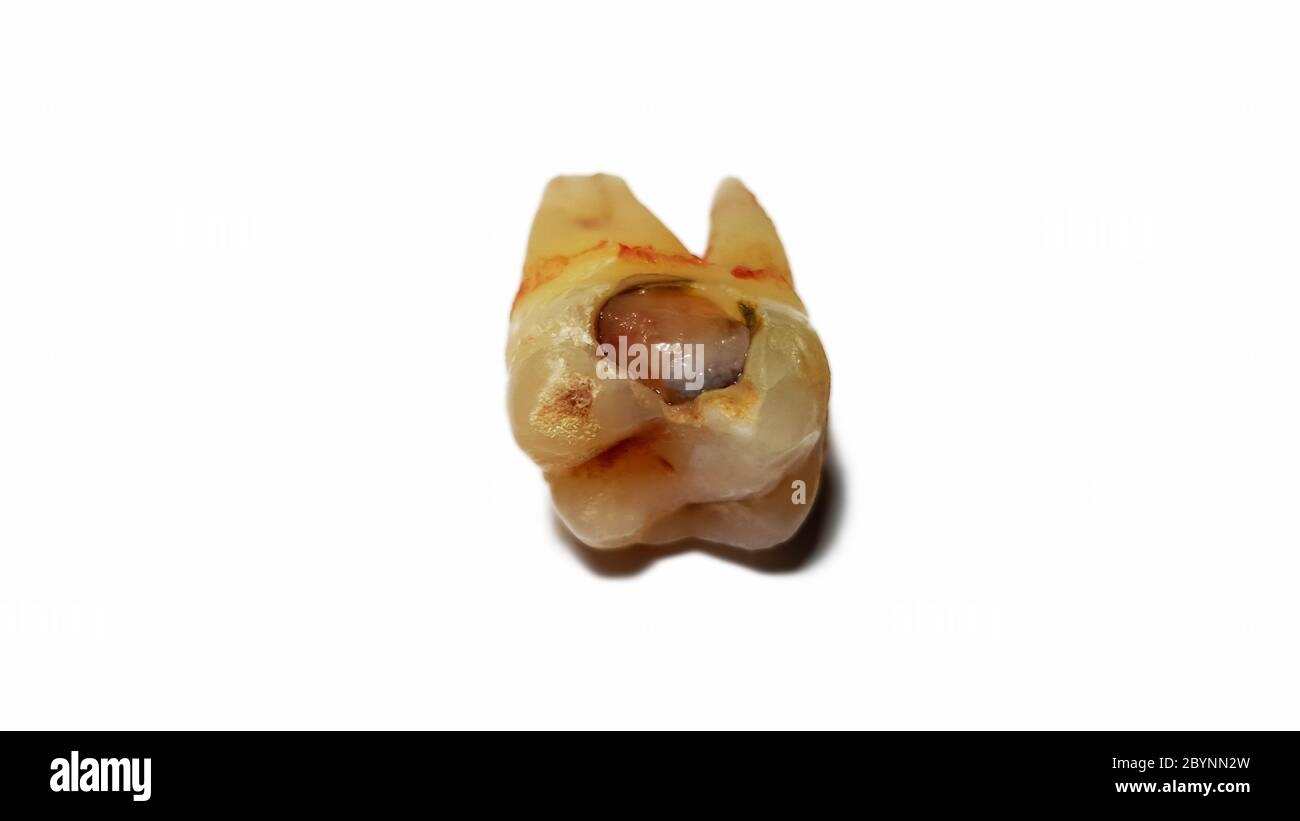close-up tooth decay isolated on white background Stock Photo - Alamy