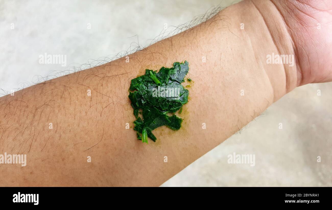 close-up centipede bite, poisonous hurt arm cure with herbal medicine ...