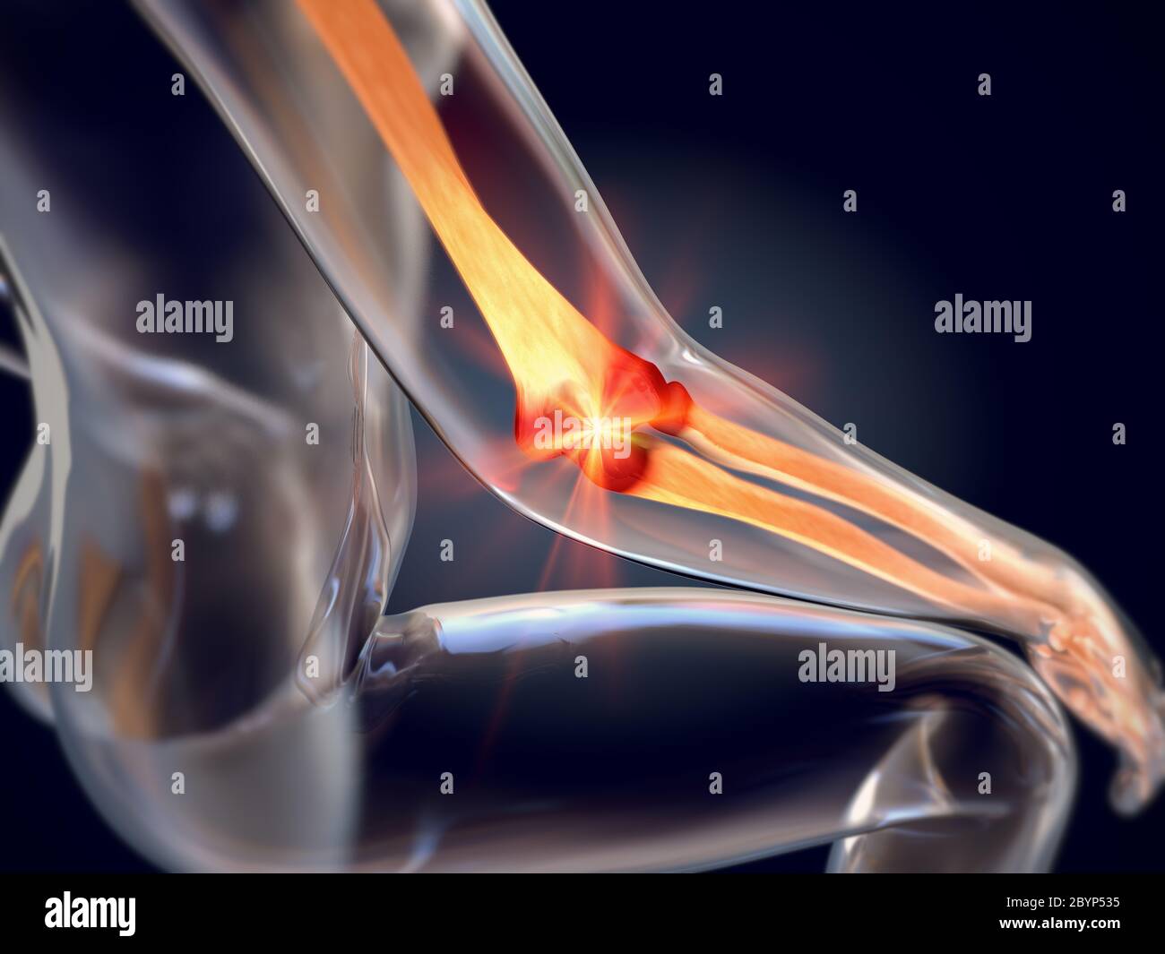 Tennis elbow hi-res stock photography and images - Alamy