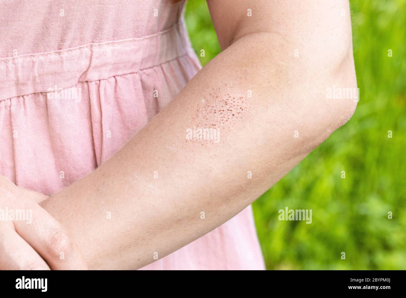 Close up of scratch the wound on the arm. Medicine and first aid ...