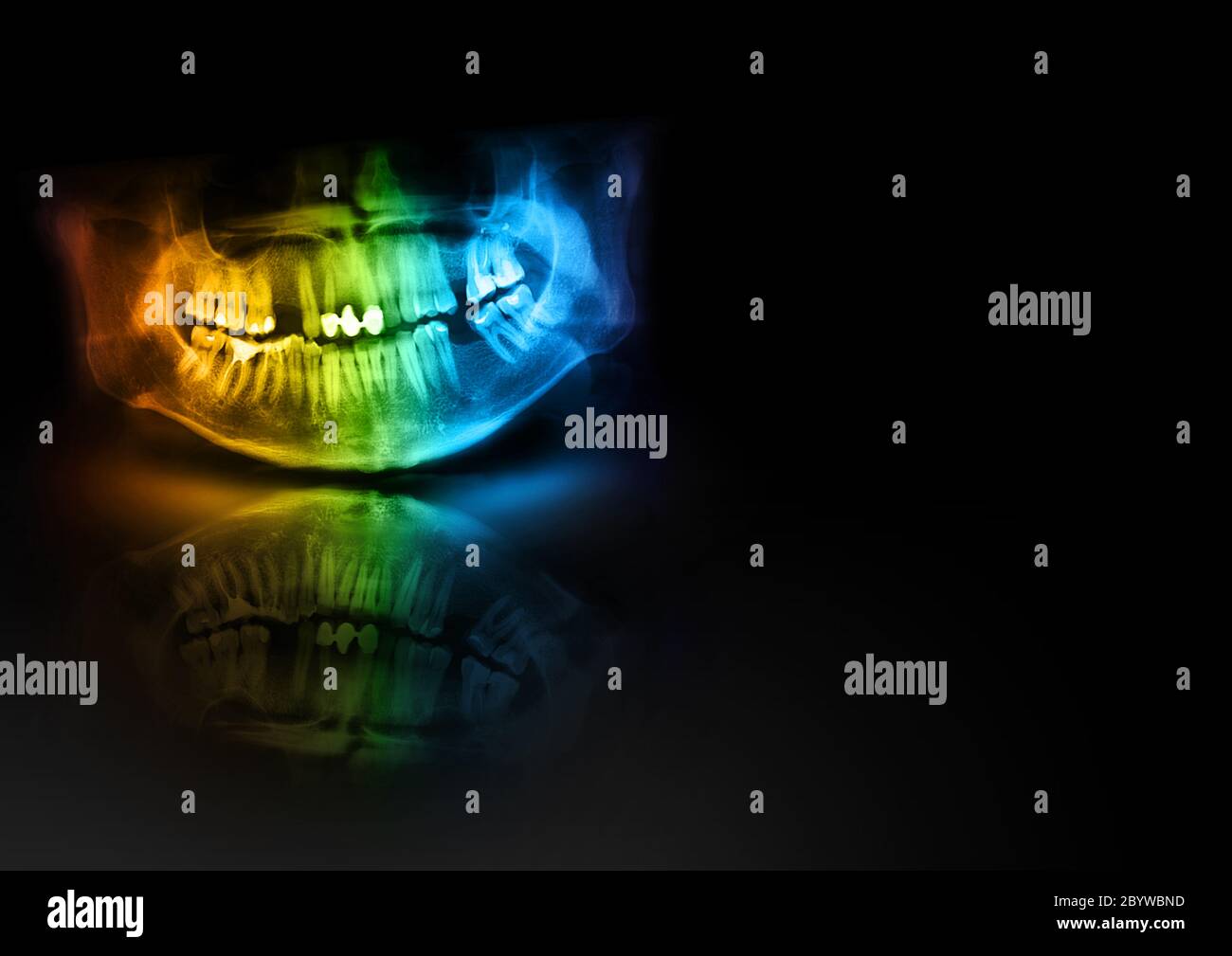 Panoramic radiograph is a scanning dental X-ray of the upper jaw ...