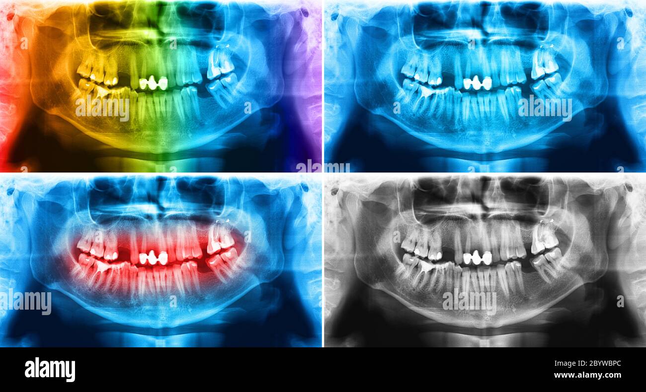 Panoramic radiograph is a scanning dental X-ray of the upper jaw ...