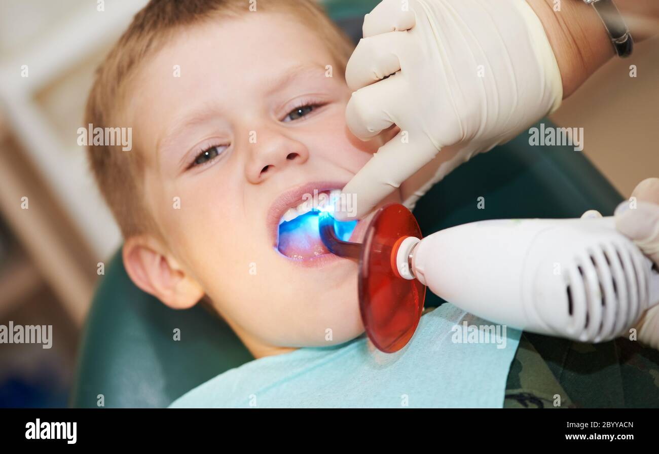 dental filing of child tooth by ultraviolet light Stock Photo - Alamy