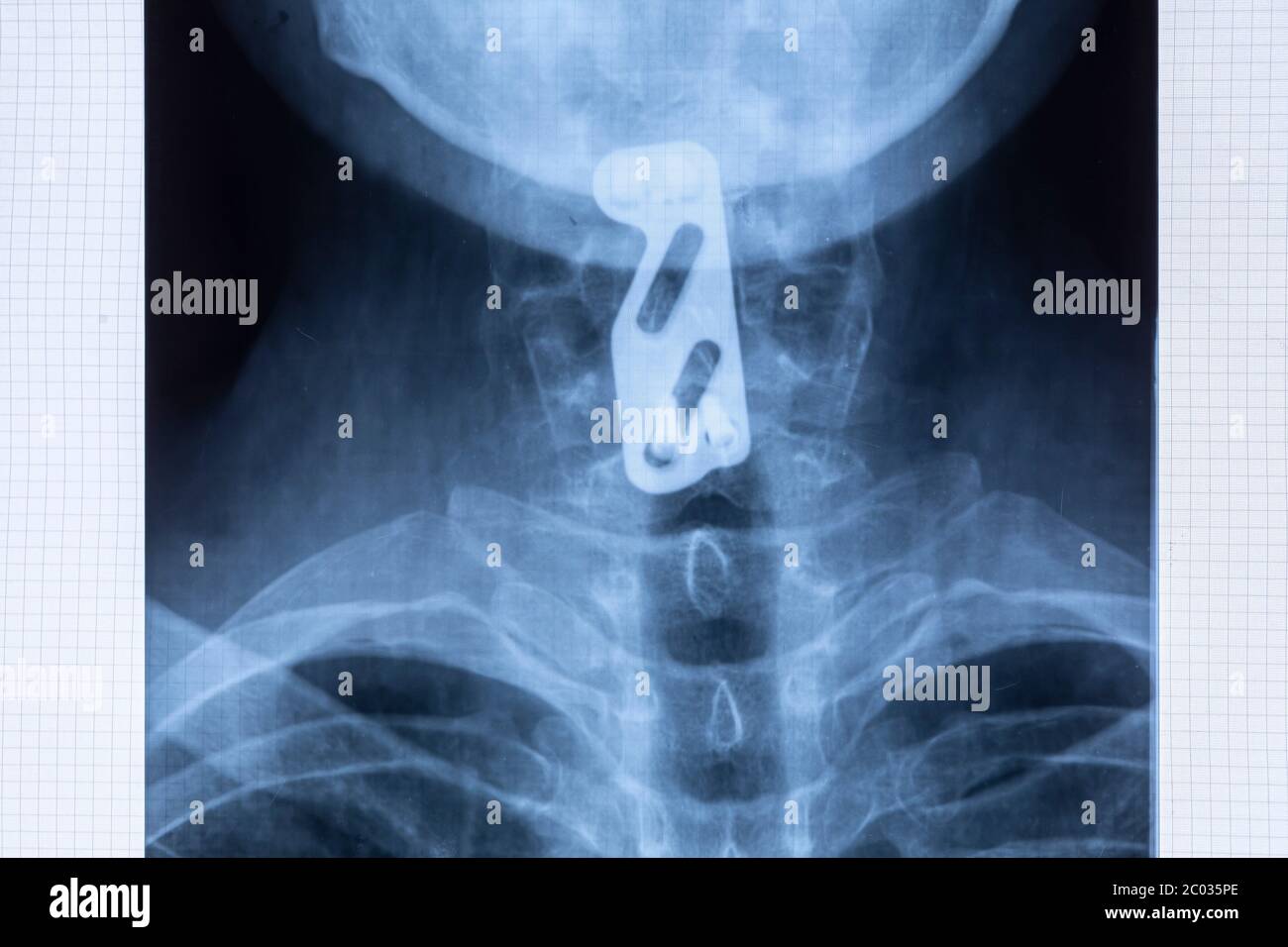 Neck X Ray Of Cervical Vertebrae High Resolution Stock Photography and ...