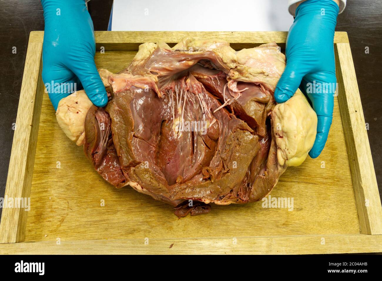 Left ventricle hi-res stock photography and images - Alamy