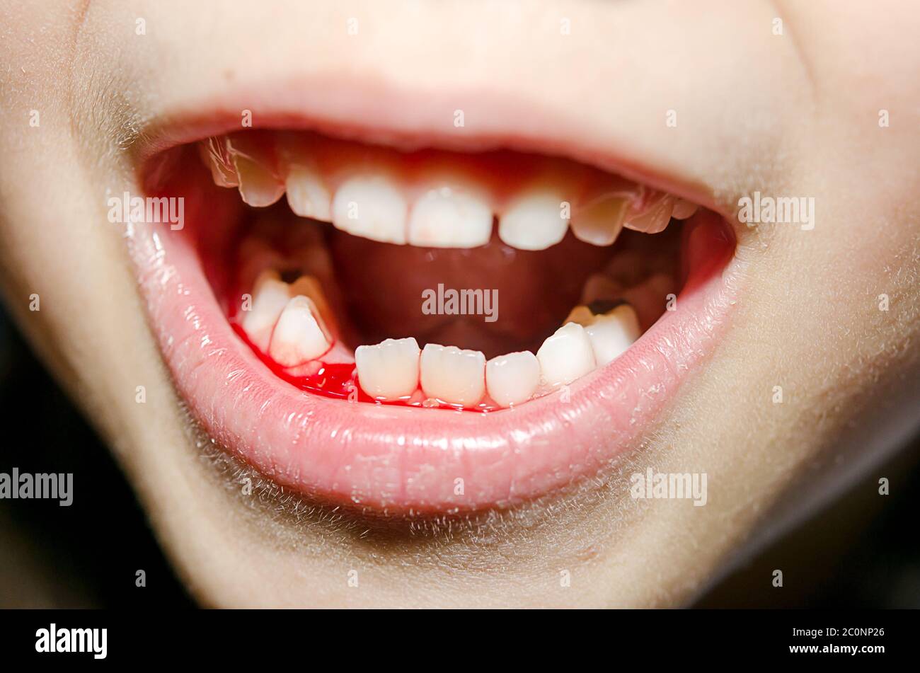 Broken teeth hi-res stock photography and images - Alamy