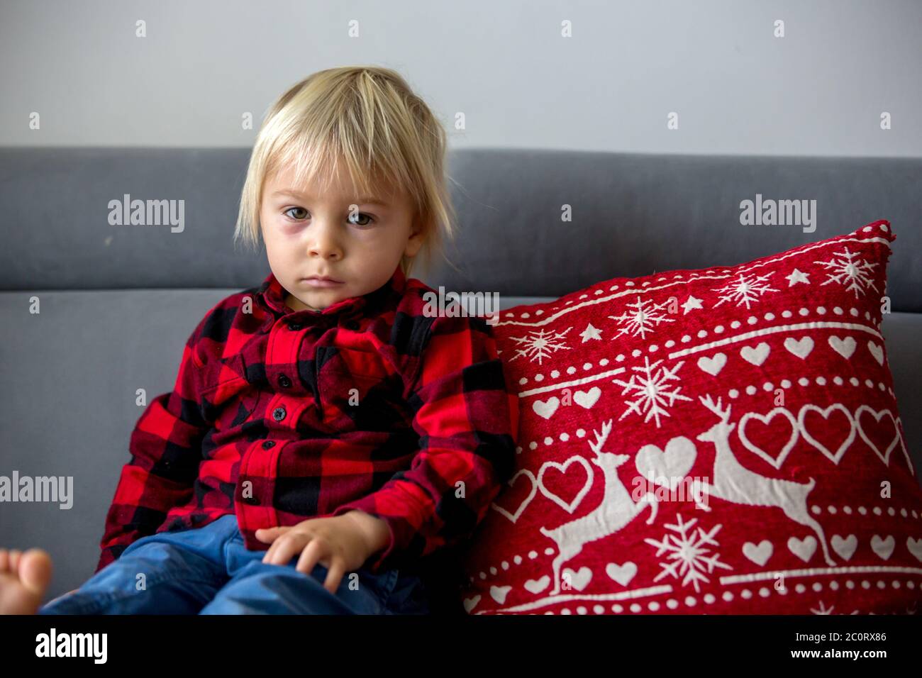Blonde toddler boy with red burned spot under the eye, feeling pain ...