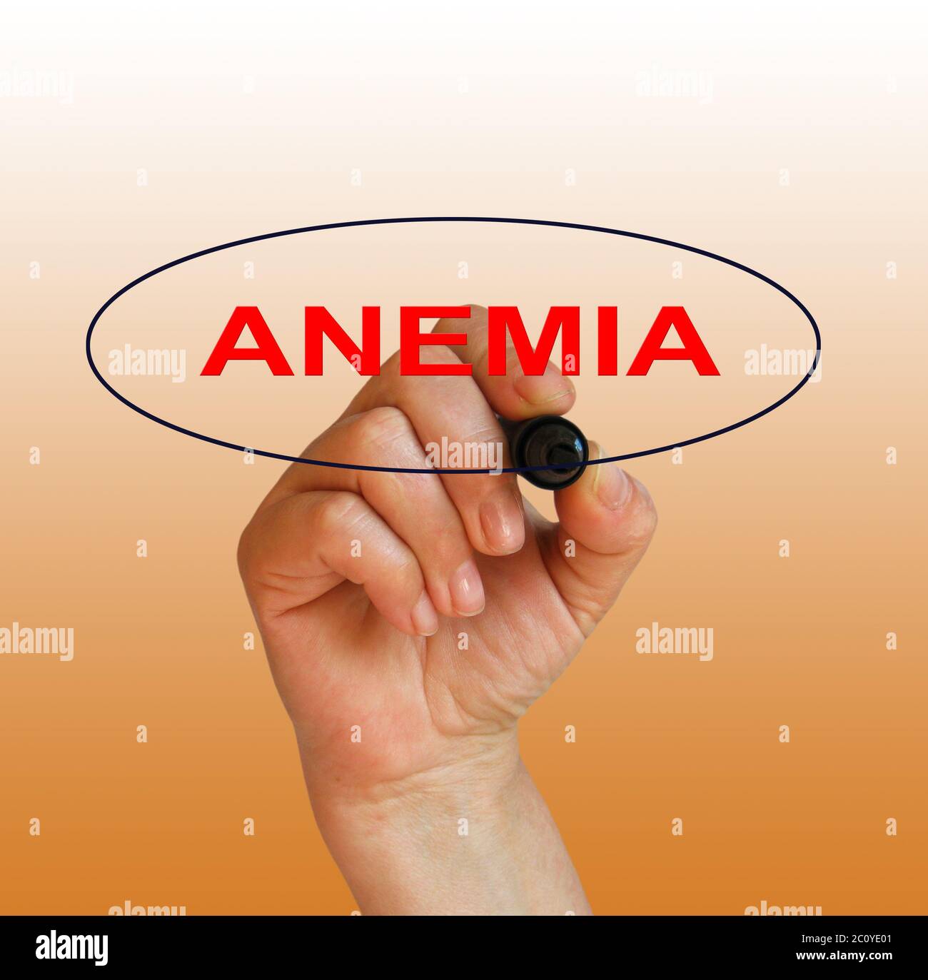 Anemia hand hi-res stock photography and images - Alamy