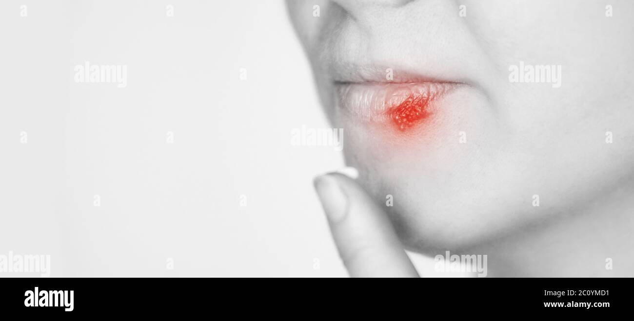 Girl with herpes. Sick symptom. Lips cold Stock Photo - Alamy