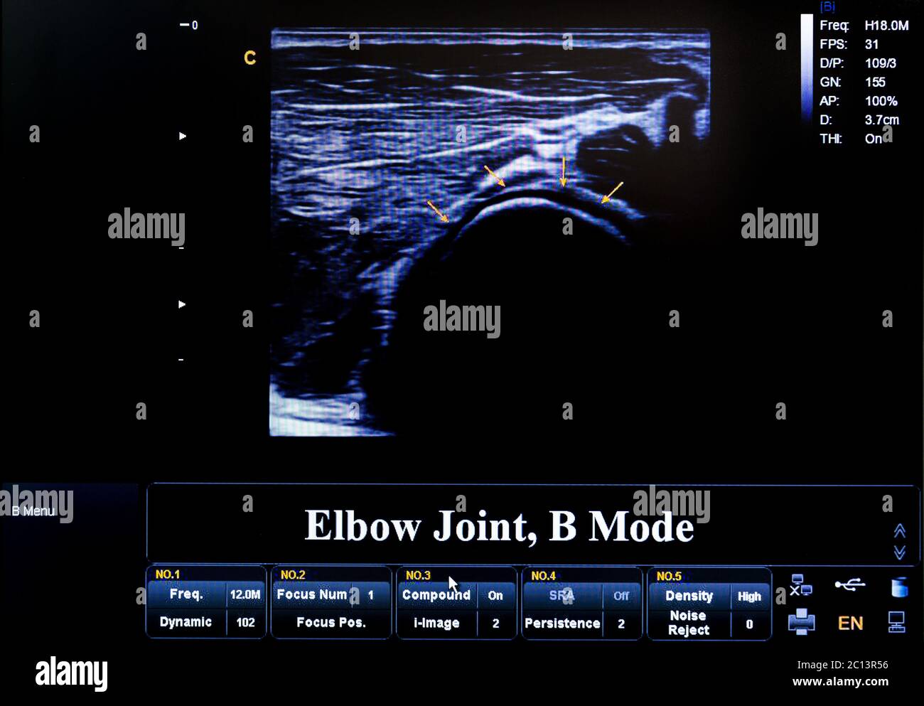Colourful ultrasound monitor image. Elbow Joint, B Mode Stock Photo - Alamy