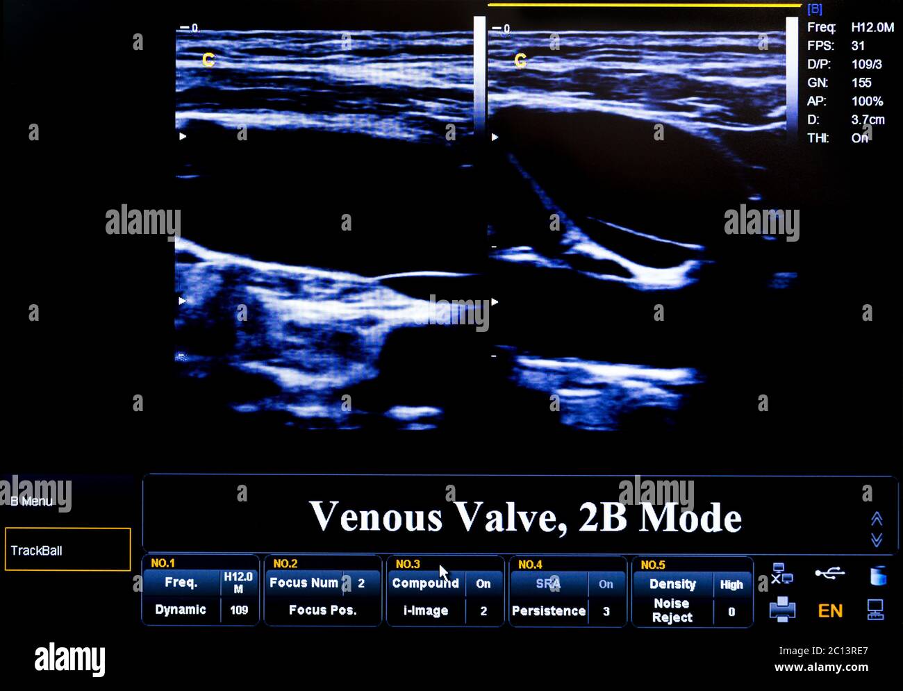 Colourful ultrasound monitor image. Venous Valve Stock Photo - Alamy