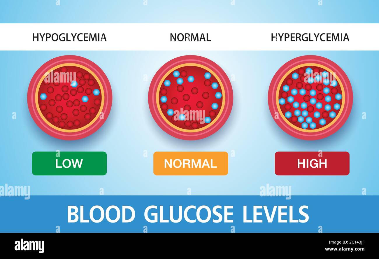 Hyperglycemia, High Blood Sugar and Diabetes ,obesity is a serious ...