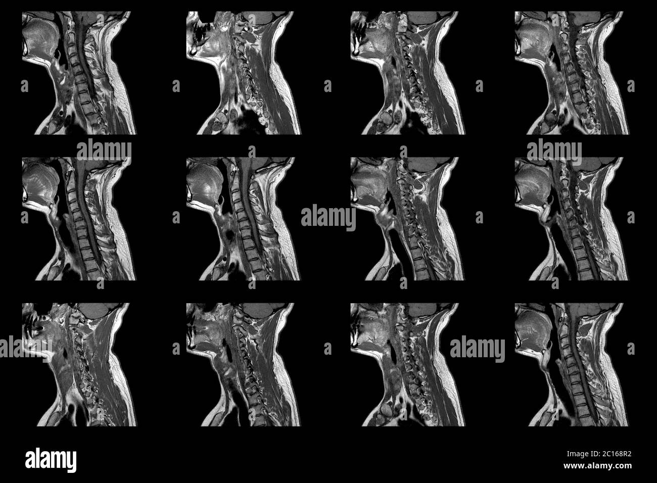 set of sagittal MRI scans of neck area of caucasian male with bilateral ...