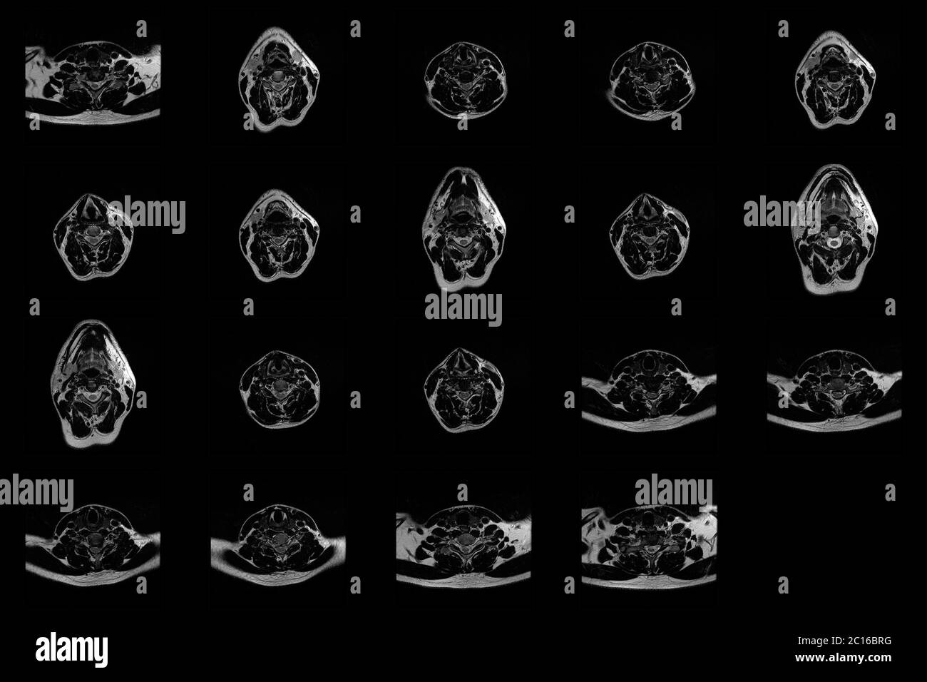 Mri for radiculopathy Black and White Stock Photos & Images - Alamy