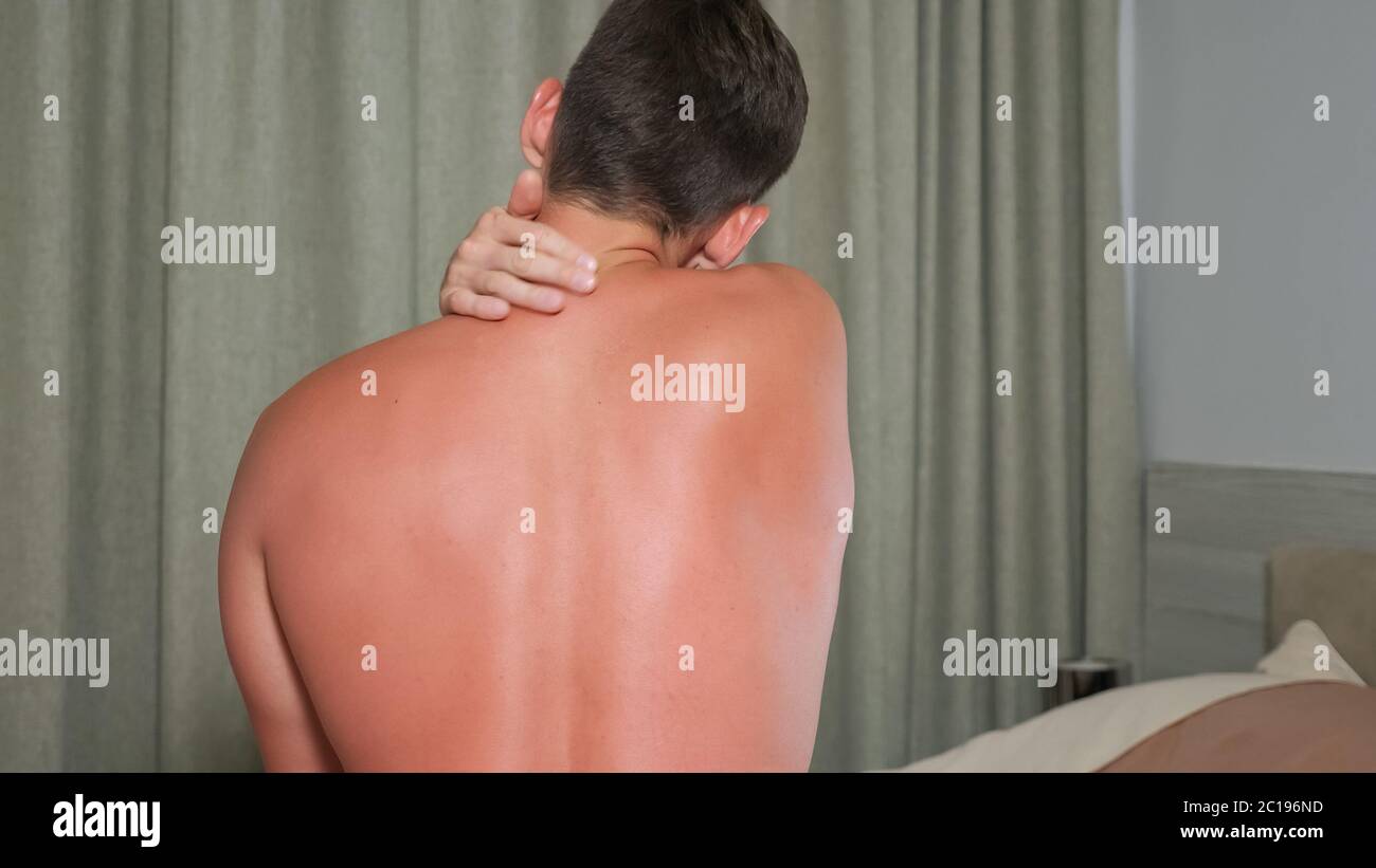 handsome guy touches red sunburned back and suffers with pain sitting ...