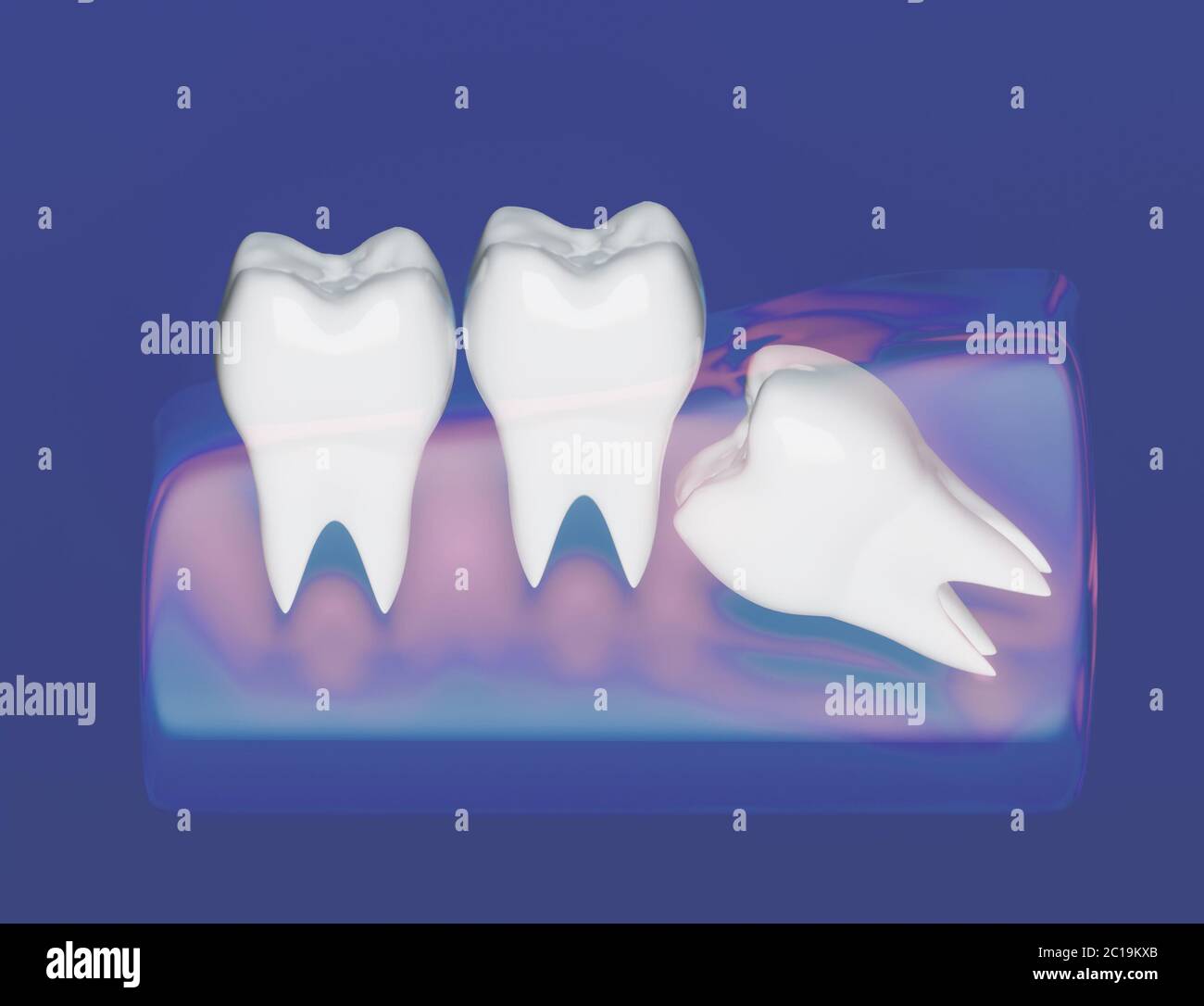 Semi Impacted Wisdom Tooth