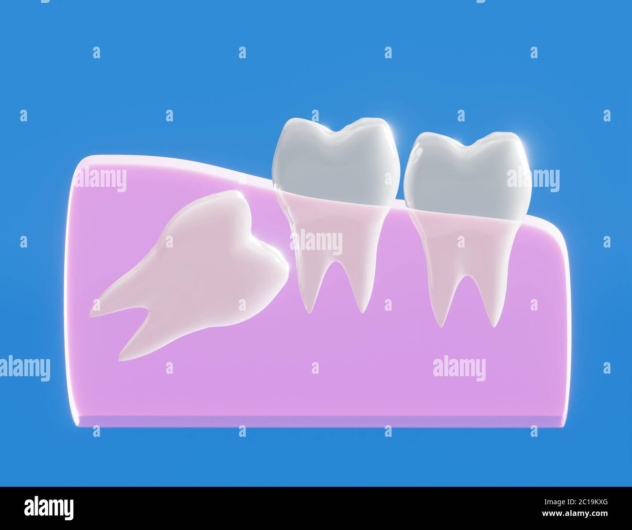 Wisdom tooth grows wrong, wisdom tooth problem, horizontal position of ...