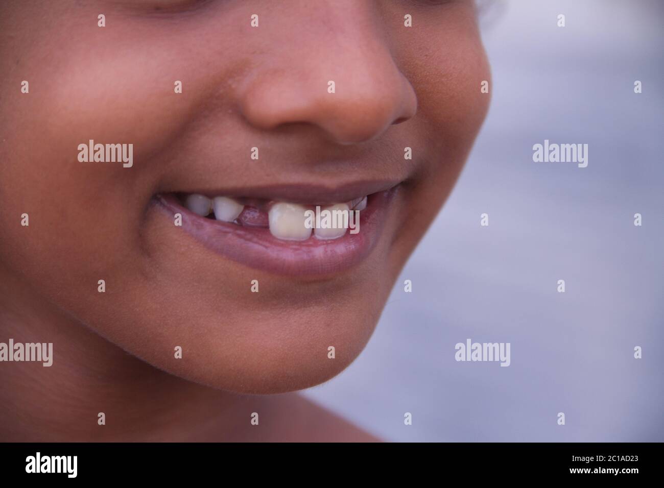 Broken teeth hi-res stock photography and images - Alamy