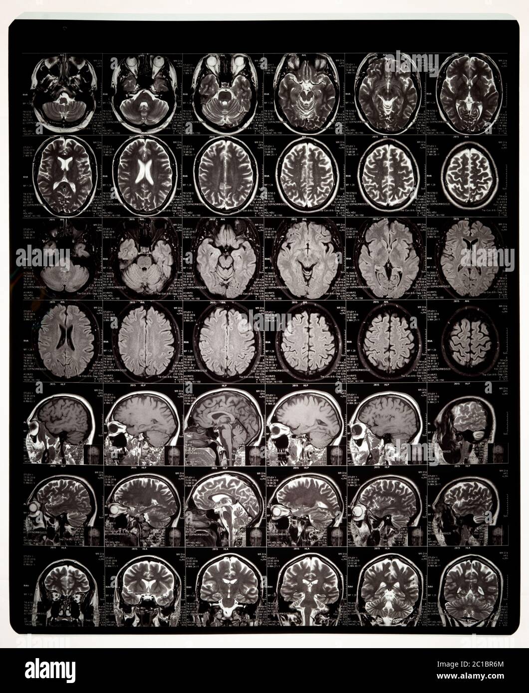 Mri scan of brain adult hi-res stock photography and images - Alamy