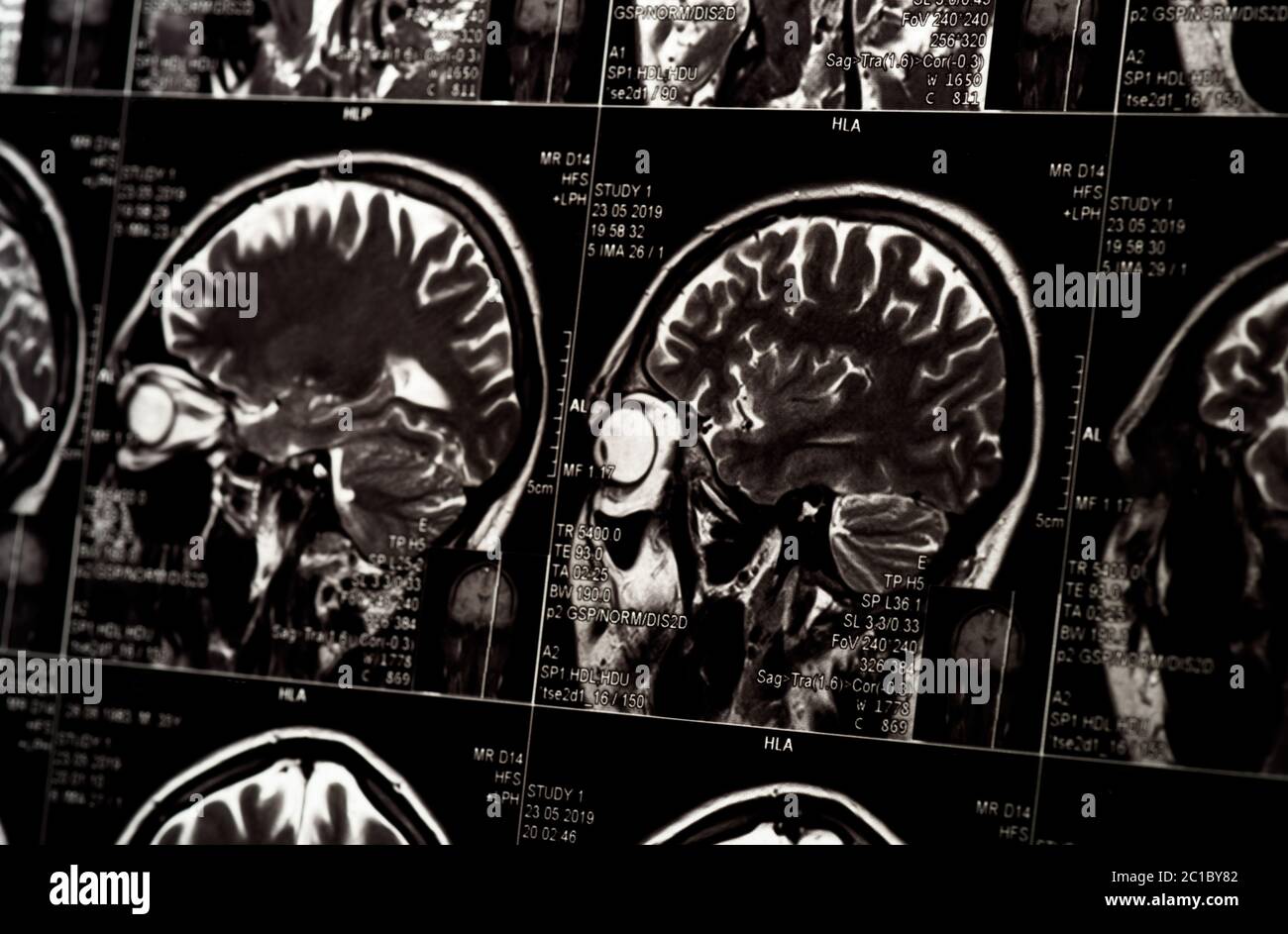 MRI scan of human brain, black and white Stock Photo - Alamy