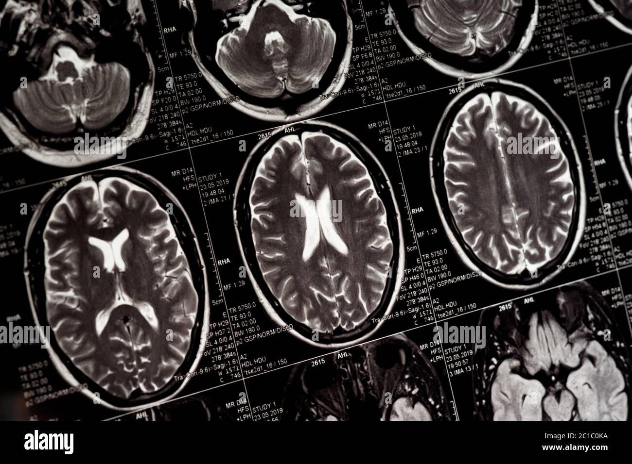 MRI scan of human brain, black and white Stock Photo - Alamy